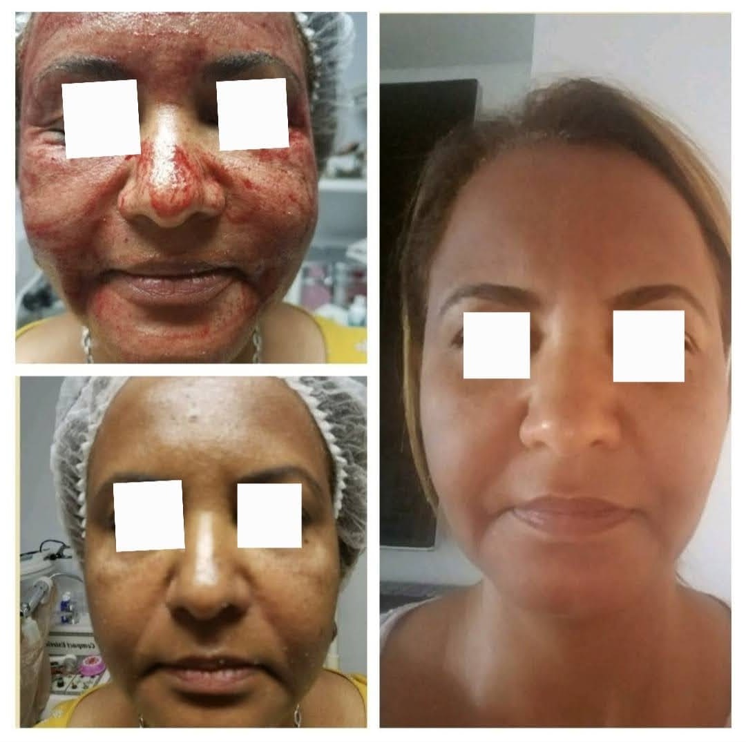 PRP Facials in Melbourne, FL | Infuse Wellness Med Spa